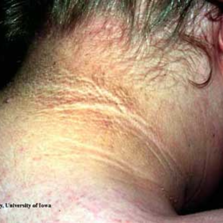Clinical Skin Disease Image Index | Department of Dermatology - Carver ...